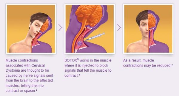 Botox for Chronic Migraines/Cervical Dystonia – Interventional Spine ...