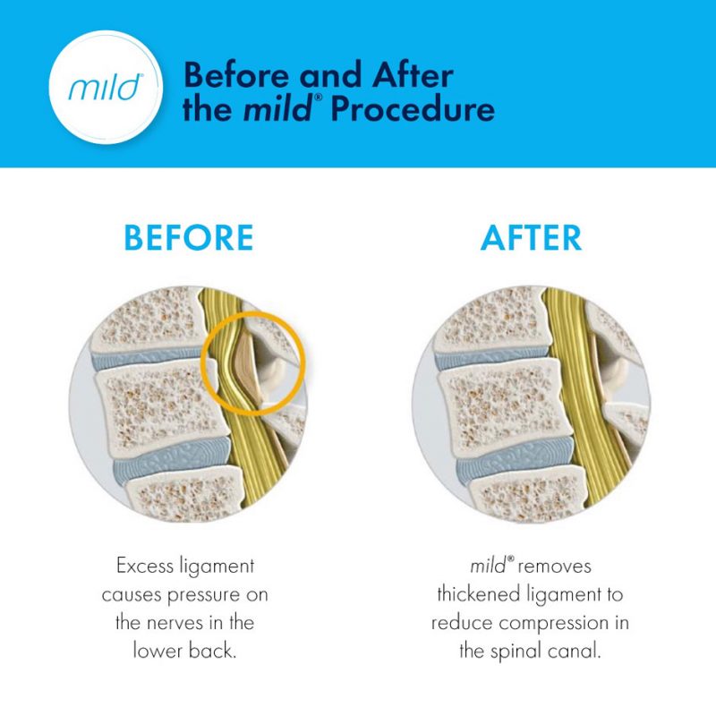 We are now offering the mild® Procedure – Interventional Spine & Sport ...